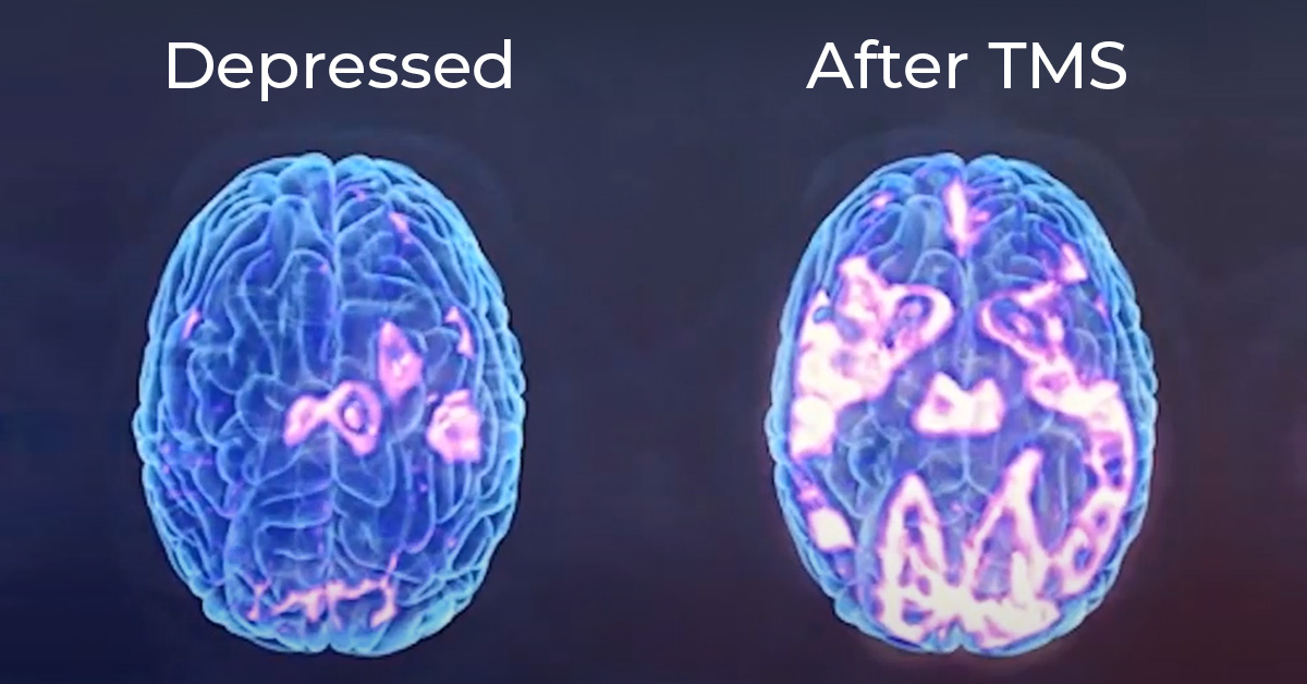 My TMS Therapy - Depression