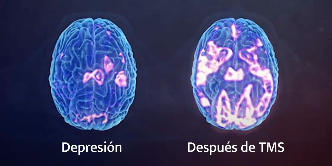 My TMS Therapy - Depresión