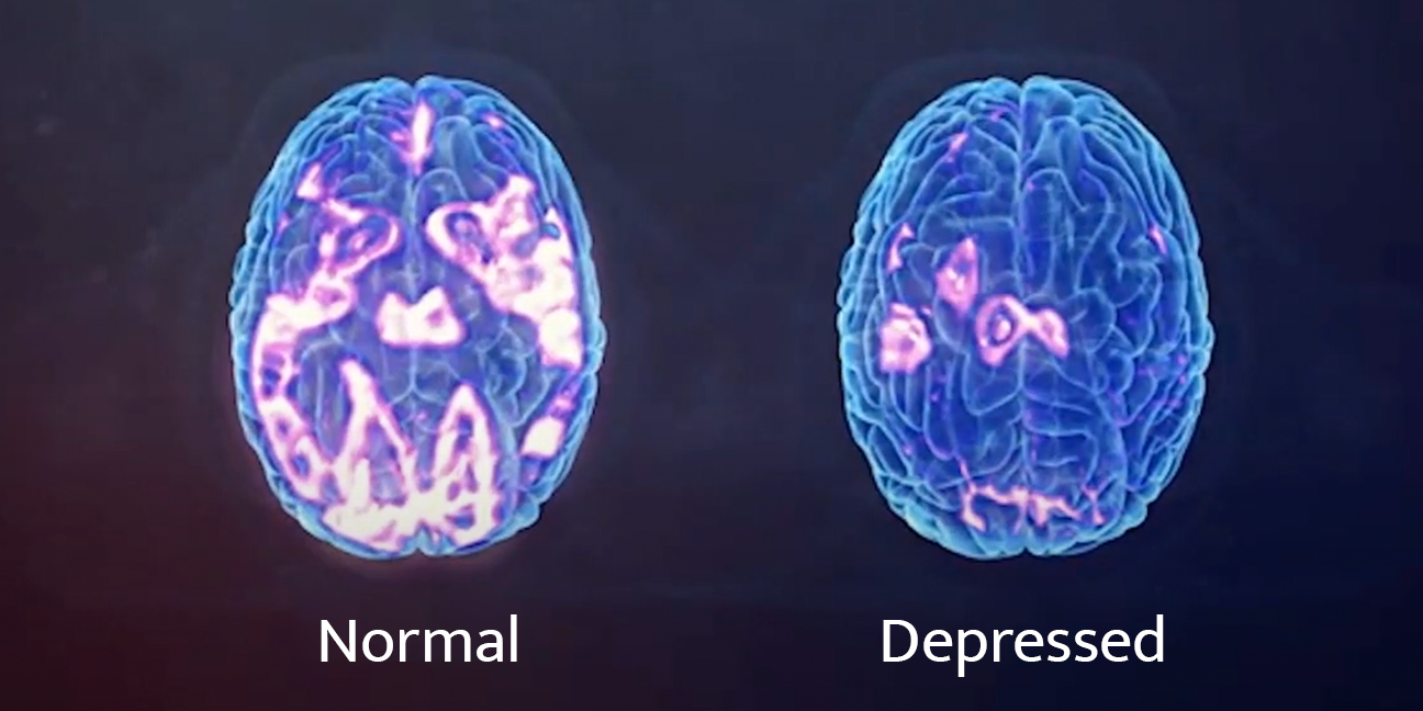 My Tms Therapy Depression